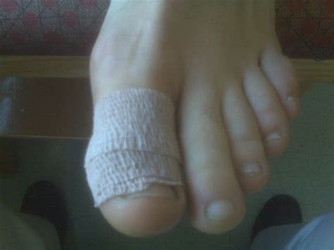 Foot And Ankle Problems By Dr Richard Blake Toe Injuries Coban Wrap For Compression And