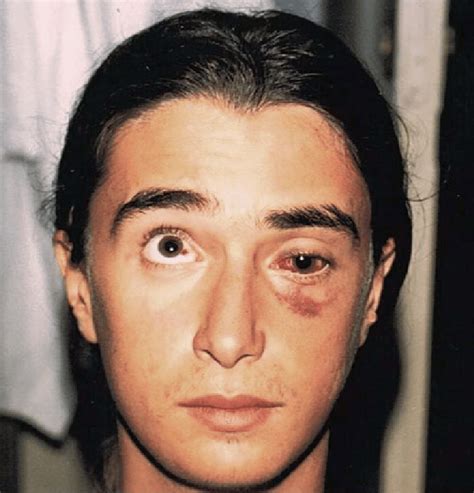 28 Vertical Diplopia Left Left Eye Does Not Follow The