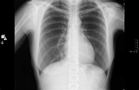Chest X Ray Showing No Abnormalities Download Scientific Diagram