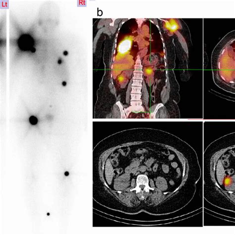 A Wbi Scan Showed Residual Functioning Thyroid Tissue With Multiple