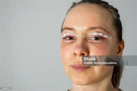 성형 수술 안검 성형술 부은 눈 주머니 제거 가능한 바늘로 절개 부은 피부 및 타박상 눈꺼풀 후 여성의 얼굴 과도한 피부 또는 지방을 제거하는 성형 수술 30 34세에 대한