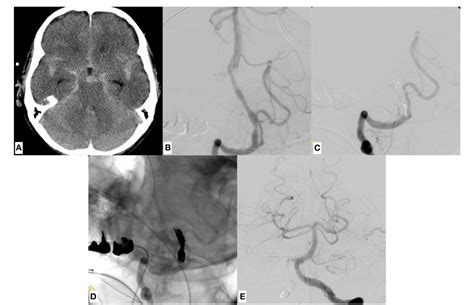 Figure 2 From Segment Occlusion Vs Reconstruction—a Single Center