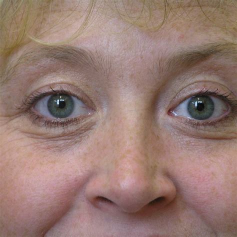 Technetium 99 Thyroid Uptake Scans Download Scientific Diagram