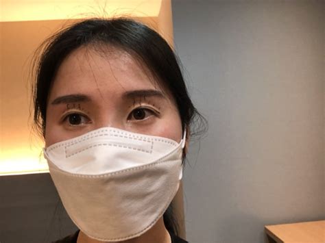 안검하수로 쌍수절개 재수술후기2주차 네이버 블로그