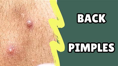 Extraction Of Back Pimples Relax With Bye Pimple YouTube