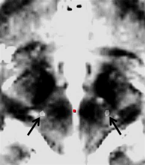 Stereotactic Intraoperative Ct Scan Fused With Stereotactic