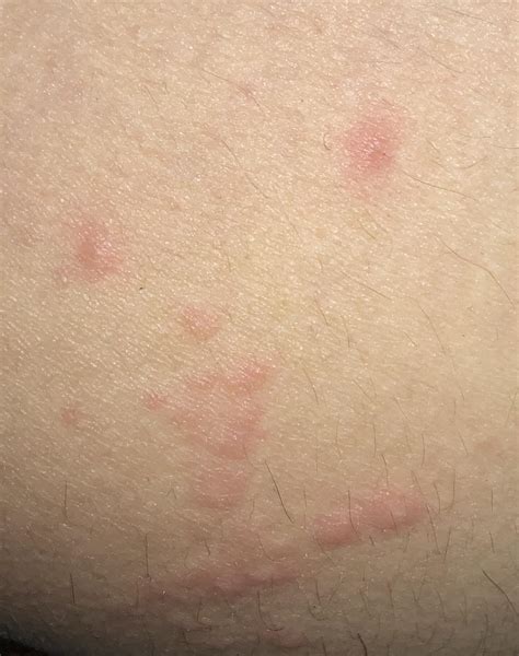 Scabies On Bum
