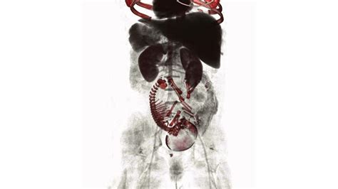 25 3d Reconstruction Ct Scan Stock Videos Footage And 4k Video Clips Getty Images