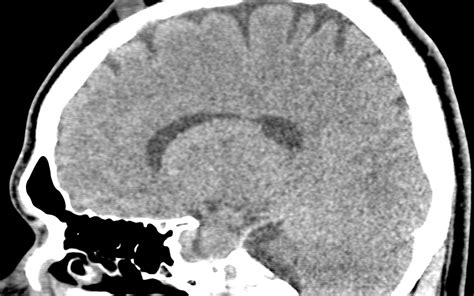 Scalp Dermoid Cyst Nr Radiology
