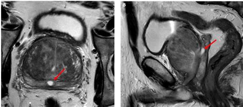 Prostatic Utricle Cyst