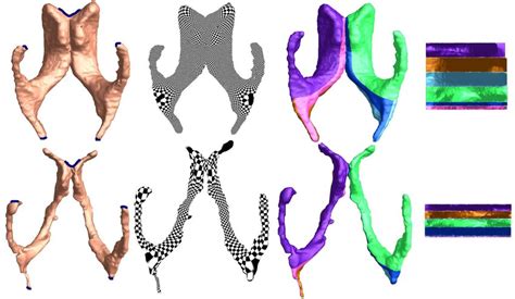 Surface Parameterization Results For The Lateral Ventricles The Upper Download Scientific