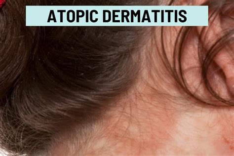 Scalp Flakes In Hair Dandruff And 8 Other Causes