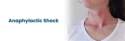 Riconoscere Lo Shock Anafilattico Sintomi E Trattamenti