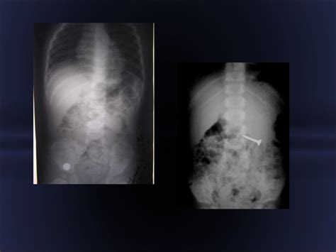 Променева діагностика захворювань шлунково кишкового тракту презентация онлайн