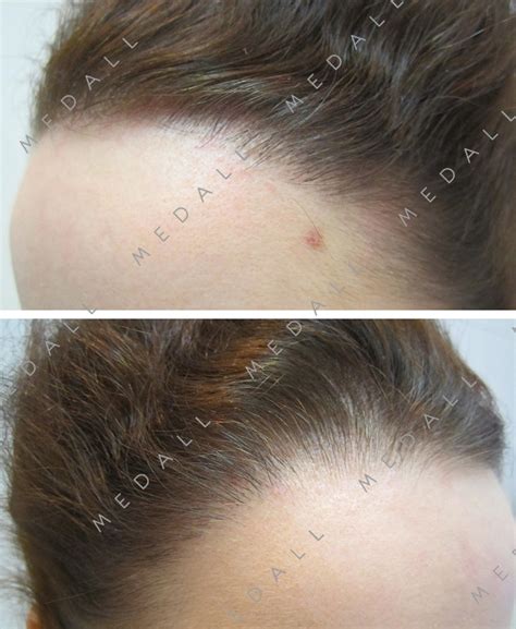 Коррекция линии роста волос пересадкой фото до и после результаты