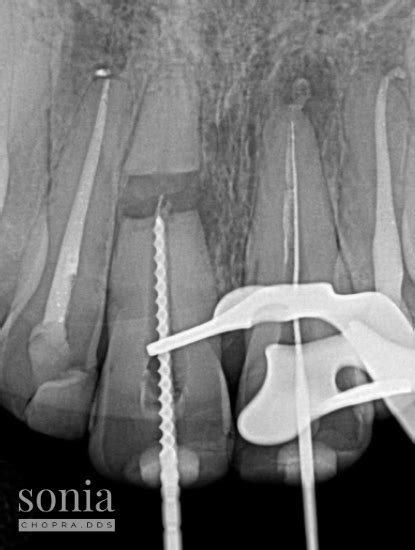 Horizontal Root Fracture Diagnosis And Treatment Sonia Chopra Dds
