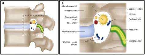 Intervertebral Foramen Nerve Infiltrations And Guided Injections