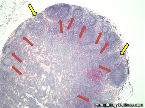 Hematologyoutlines Atlas