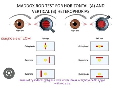 Muhammad Husnain Bodla On Linkedin Maddox Rod Test