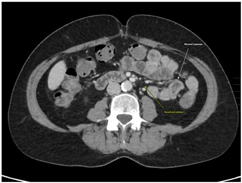 Recurrent Intestinal Angioedema With Normal C1 Inhibitor A Case Report