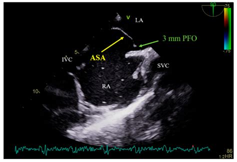 Embolization Of Patent Foramen Ovale Closure Device—rare Complication