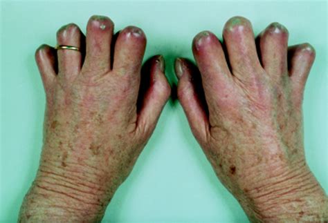 Calcinosis