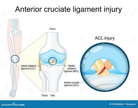 Anterior Cruciate Ligament Injury Close Up Of A Human Knee Joint Stock