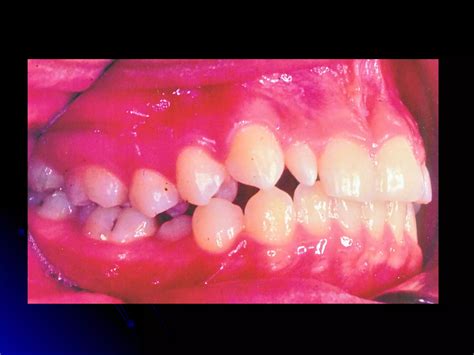 Classification Of Normal Occlusion And Malocclusion Ppt Dental