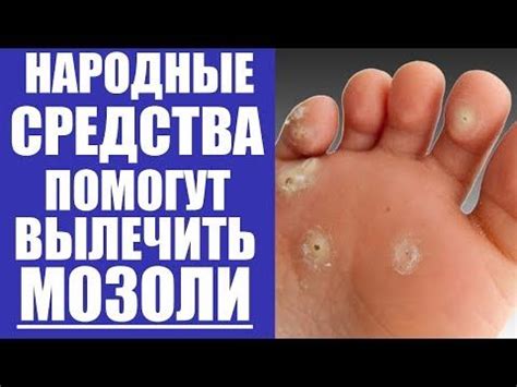 Сухая мозоль на стопах и на пальцах ног крайне неприятное, а иногда и ...