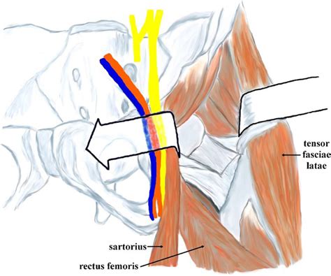 Anterior Approach To The Hip Joint Overview Download Scientific Diagram