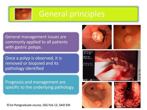 Management Of Gastric Polyps Pptx