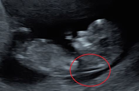 What Is A Nuchal Translucency Scan The Ultrasound Suitethe Ultrasound Suite