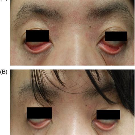Improvement Of Dupilumab‐associated Conjunctivitis After Switching To Upadacitinib In A Patient