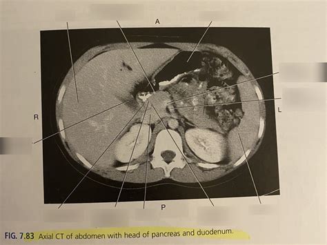 Axial Ct Abdomen W Head Of Pancreas And Duodenum Diagram Quizlet