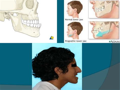 Class Iii Malocclusion Class Iii Malocclusion British