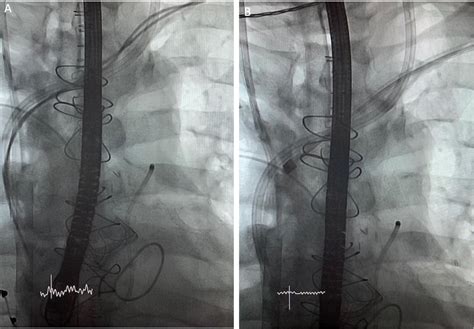 Laser Lead Extraction Procedure At Alma Jones Blog