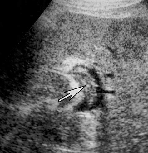 Echinococcus Multilocularis Revisited Ajr