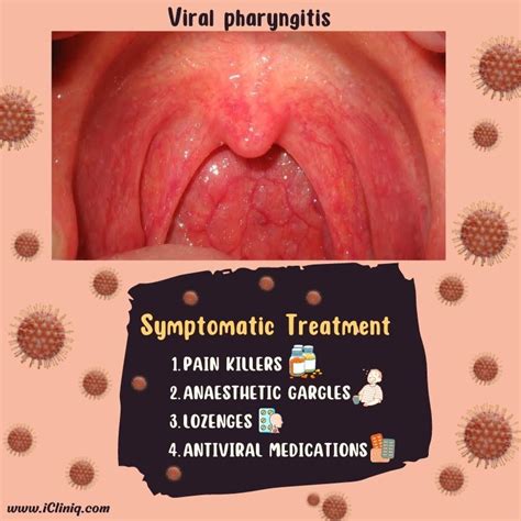 Glory Info About How To Treat Viral Pharyngitis Commonlab23