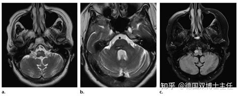 图文并茂：快速了解延髓解剖结构及常见综合征 知乎