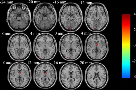 Alff Analysis Of Resting‐state Brain Activity For A Carriers Vs