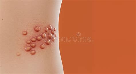 Medical Illustration Of Chagas Disease Cutaneous Form Close Up Of Skin