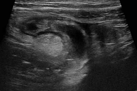 Abdomen And Retroperitoneum 1 5 Appendix Case 1 5 2 Uncomplicated Appendicitis Ultrasound