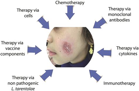 Leishmania Tropica Treatment