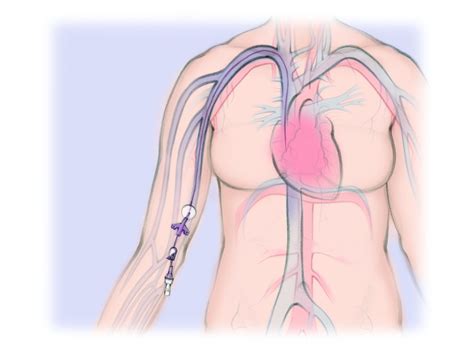 Peripherally Inserted Central Catheter Picc — The Interventional