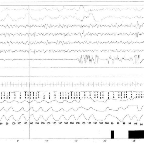 Frequency Of Total Arousal Cortical Arousal And Subcortical