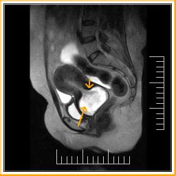 Pedunculated Cervical Fibroid Polyp Sumer S Radiology Blog