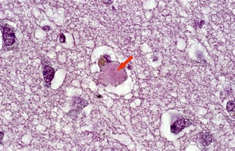 Alzheimers Disease Light Micrograph Stock Image C060 3276 Science Photo Library