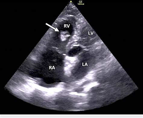 Focused Cardiac Ultrasound Apical Four Chamber Window Demonstrating A