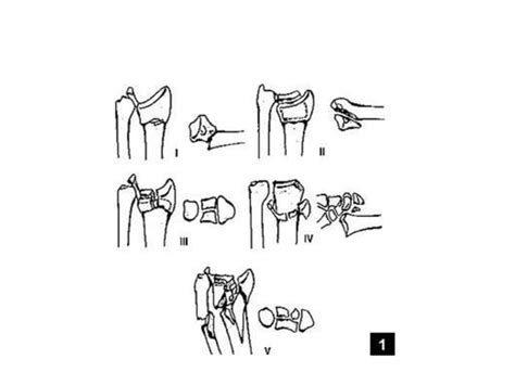 Distal Radius Ppt Free Download Distal Radius Ppt Free Download