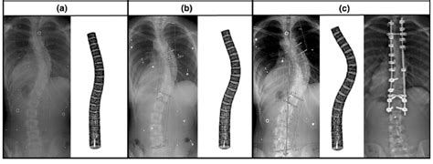 Patient Radiographs And Non Instrumented Scoliotic Model At A 13 Years Download Scientific